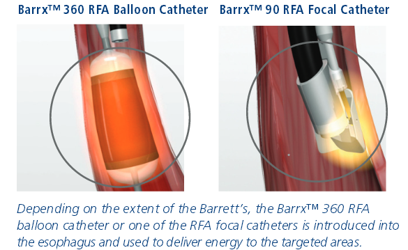 Treatment for Barrett's Esophagus with Barrx | Tulsa Heartburn & Reflux ...
